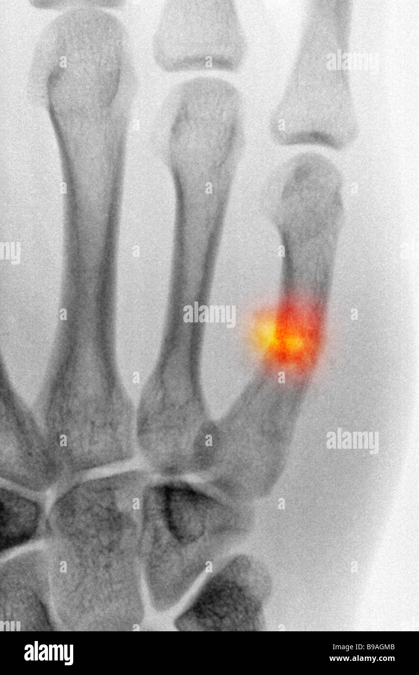 colorized x-ray showing a healing boxers fracture, a break in the 5th ...