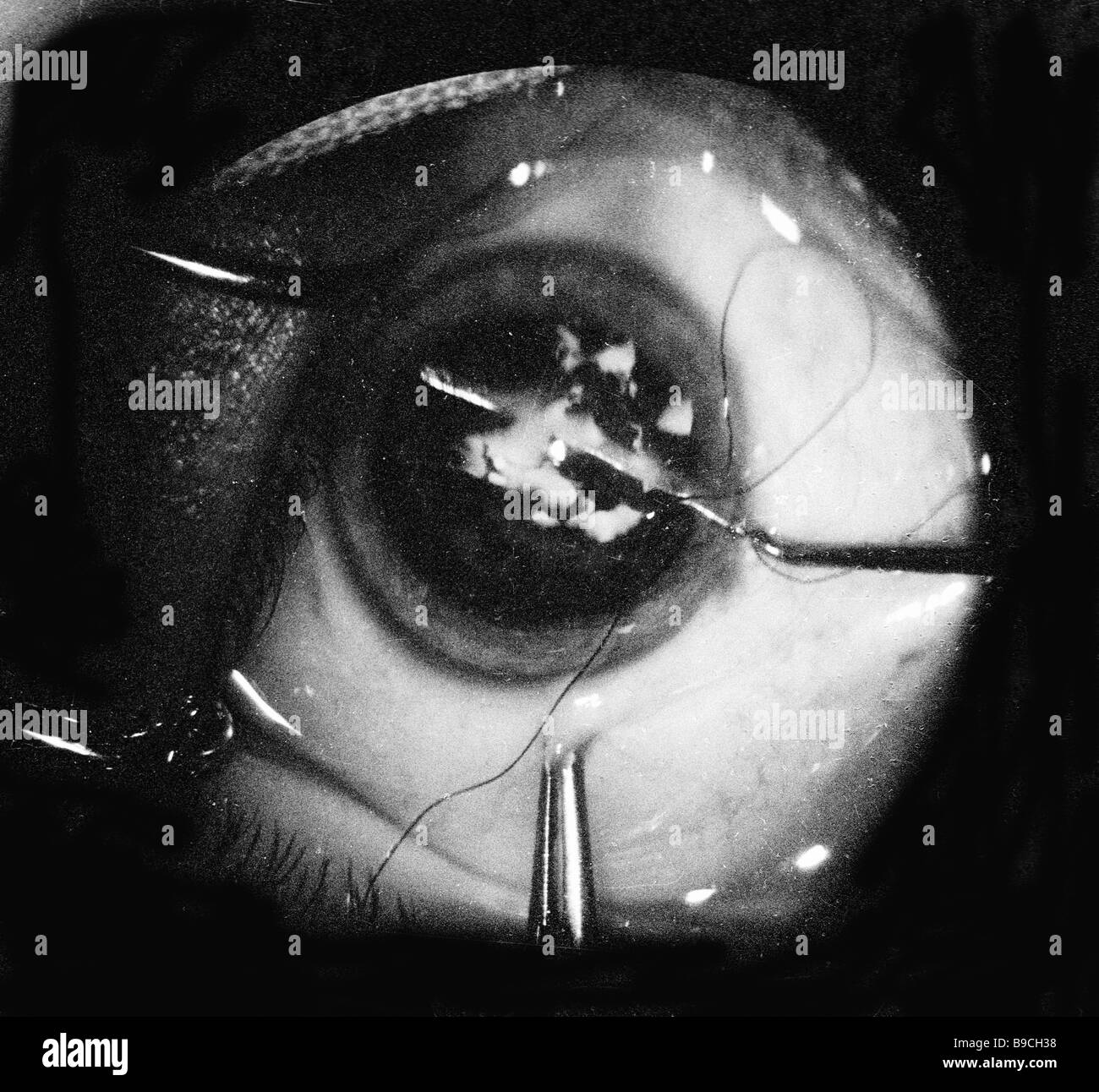 An enlarged view of an eye operated on for cataract by the Helmholtz ...