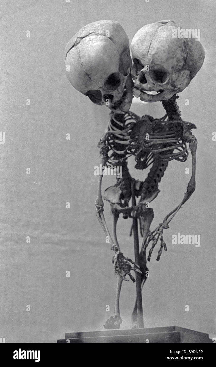 A two headed and three armed freak from Peter the Great s anatomical ...