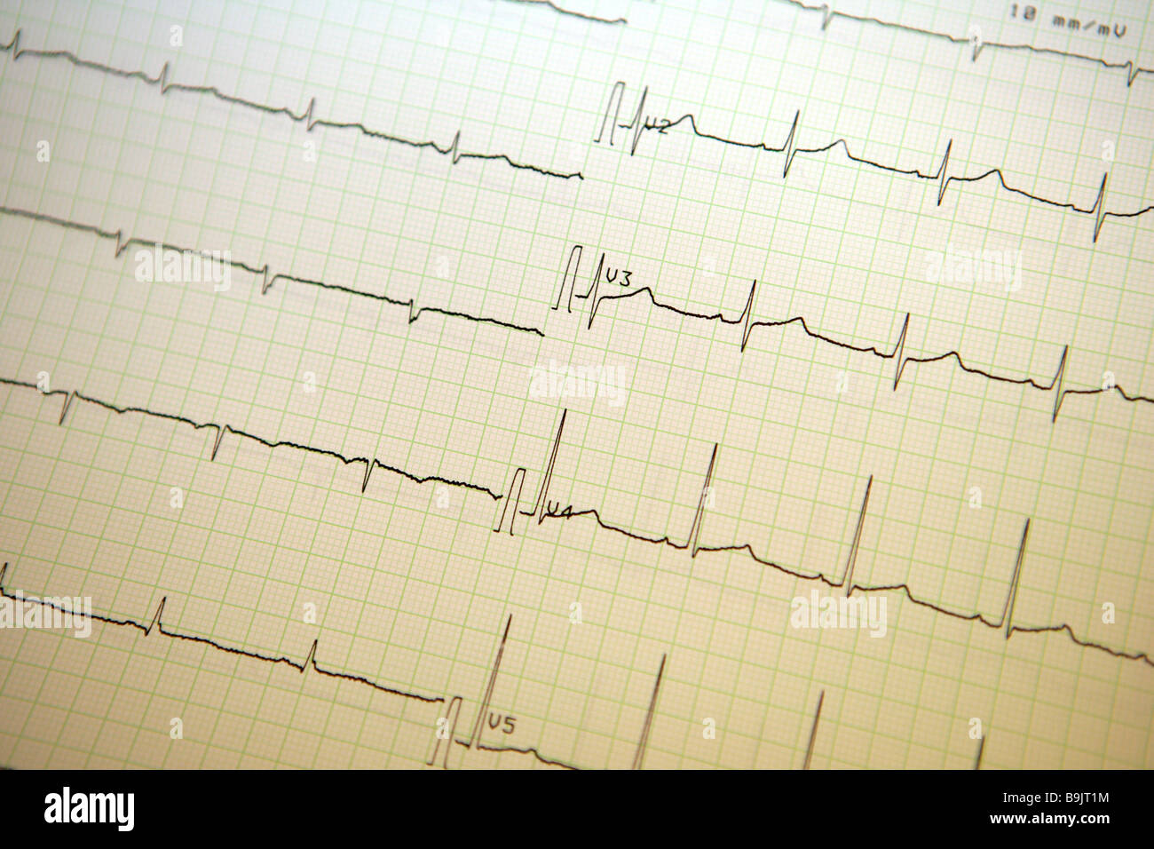 ECG expression record Stock Photo - Alamy