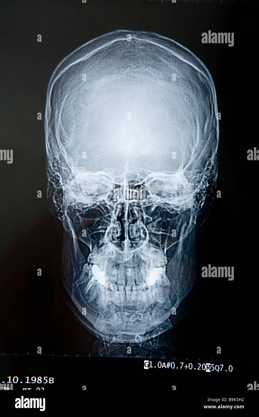 the first floor of a radiograph of a human skull Stock Photo - Alamy