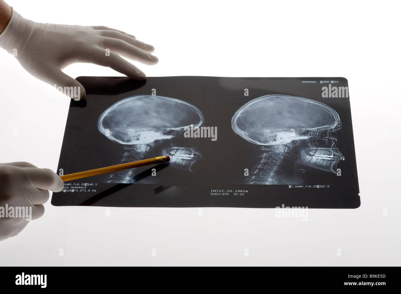 the first floor of a radiograph of a human skull Stock Photo - Alamy