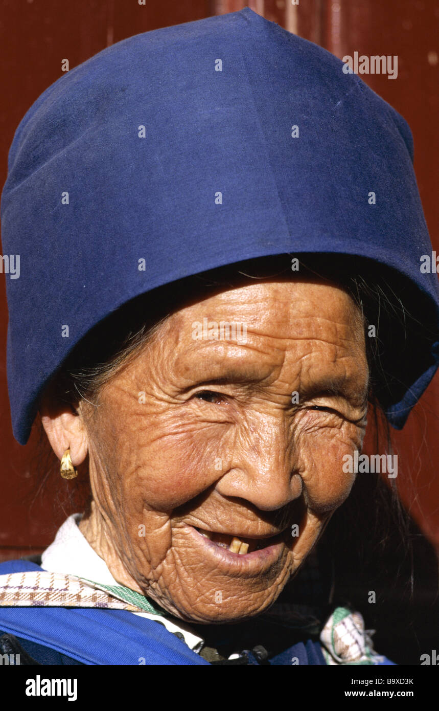 Exfoliation of teeth hi-res stock photography and images - Alamy