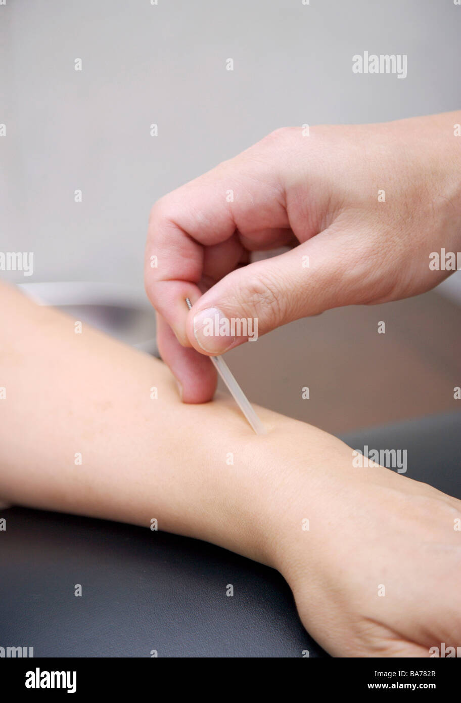 Acupuncture palm hi-res stock photography and images - Alamy