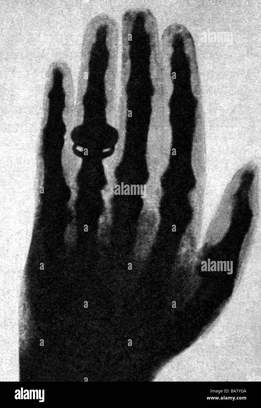 Roentgen hand hi-res stock photography and images - Alamy