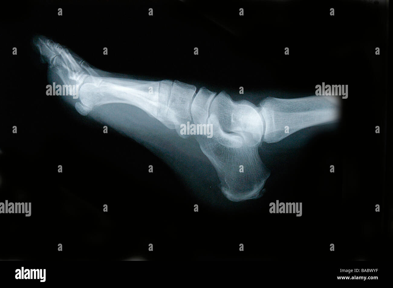 Foot xray hi-res stock photography and images - Alamy