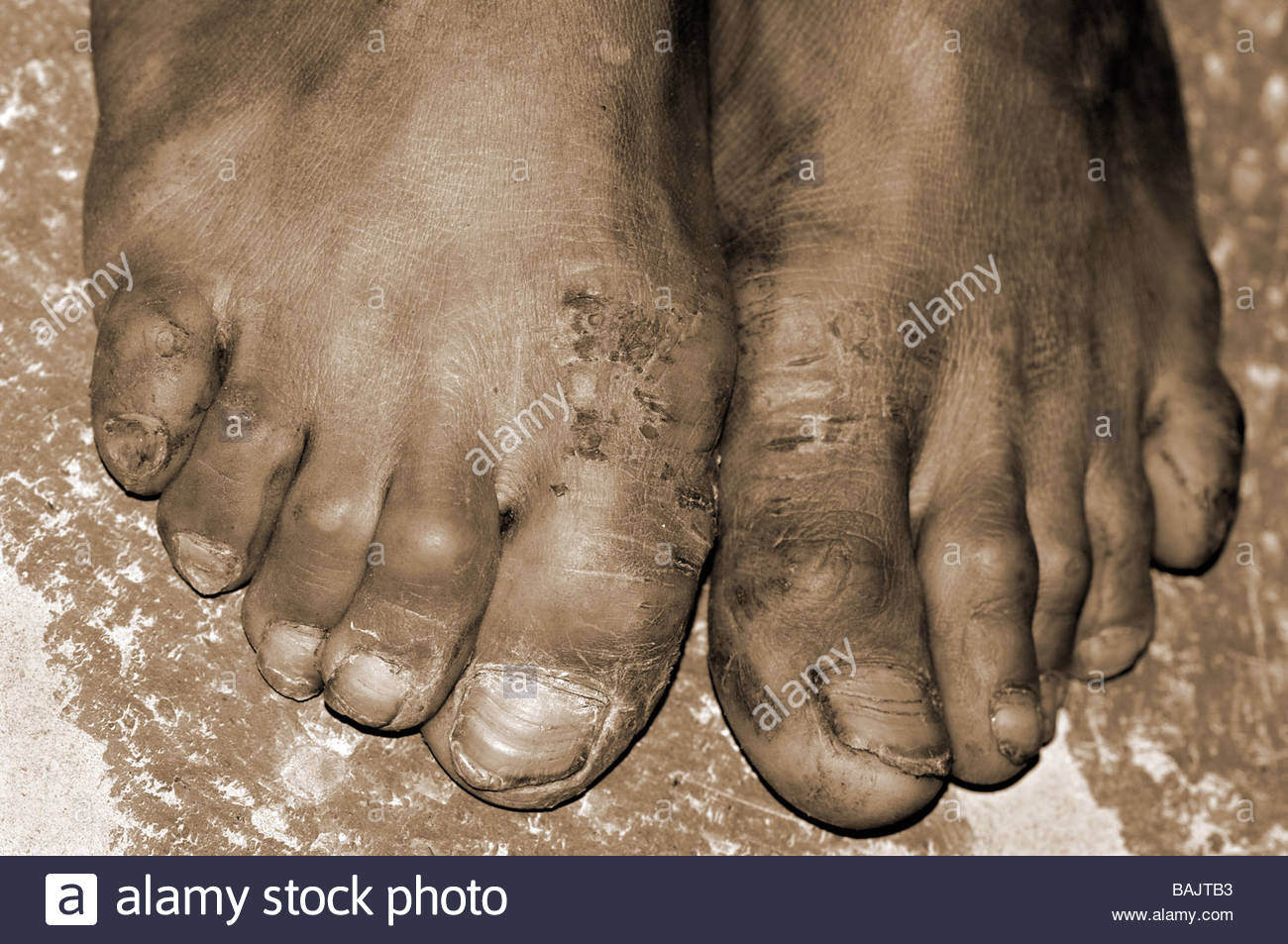 Street Poor Children Feet High Resolution Stock Photography and Images ...