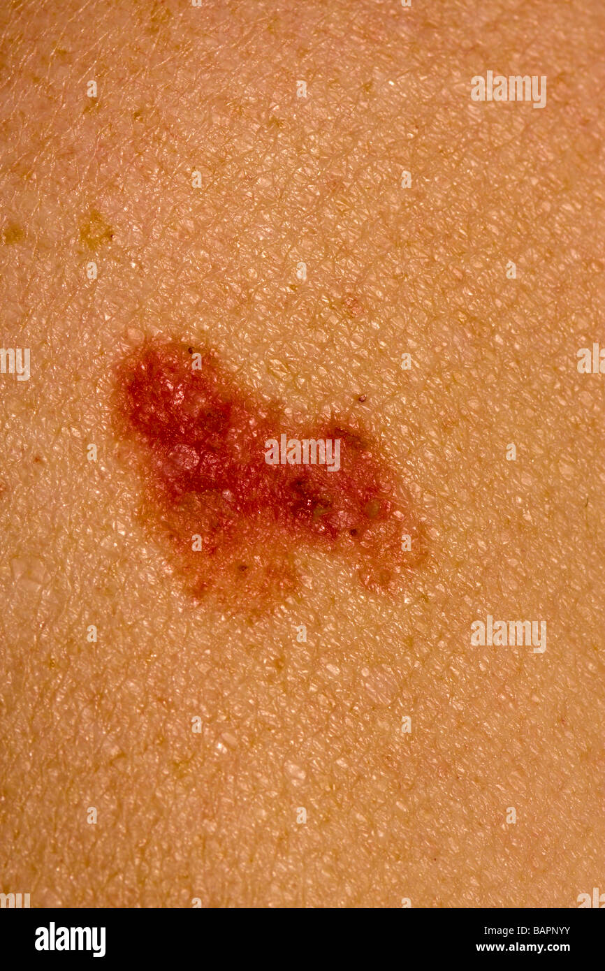 Basal Cell Carcinoma Stock Photo - Alamy