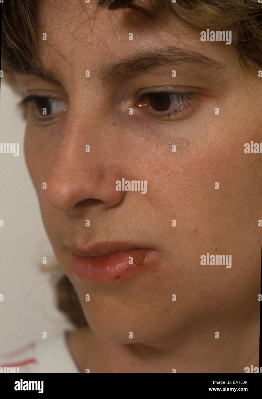 Cold sores close up hi-res stock photography and images - Alamy