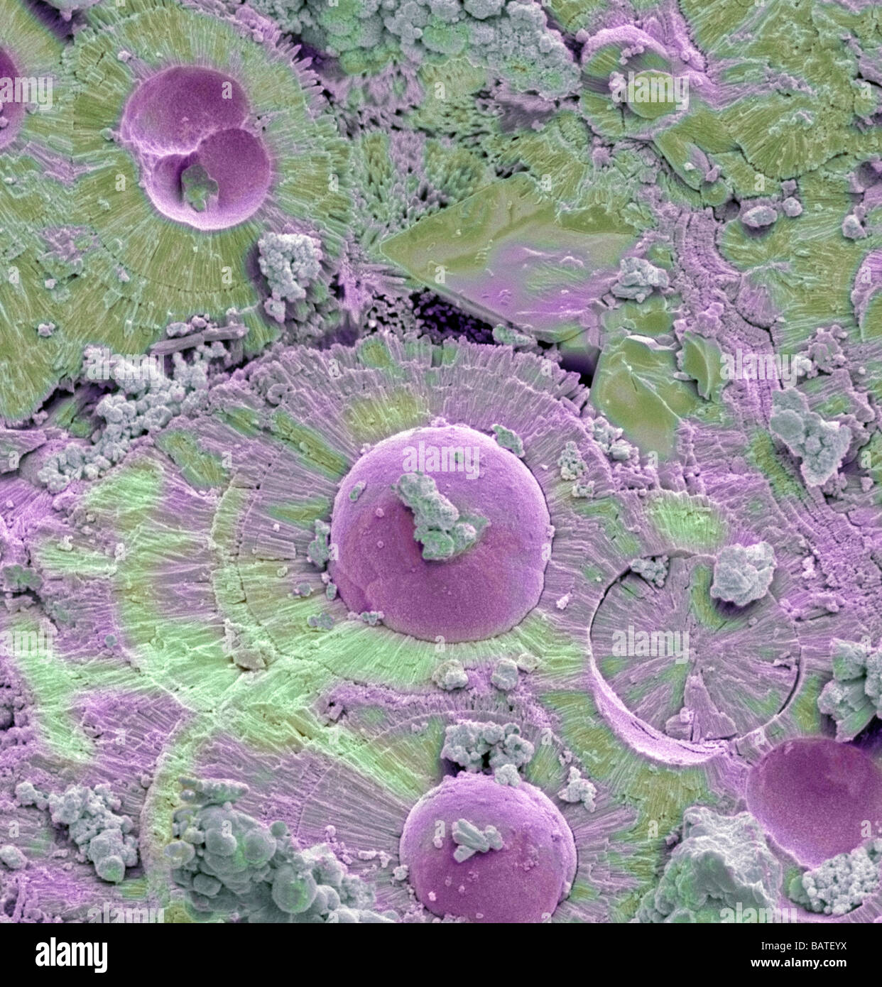 Bladder stone. Coloured scanning electronmicrograph (SEM) of a ...