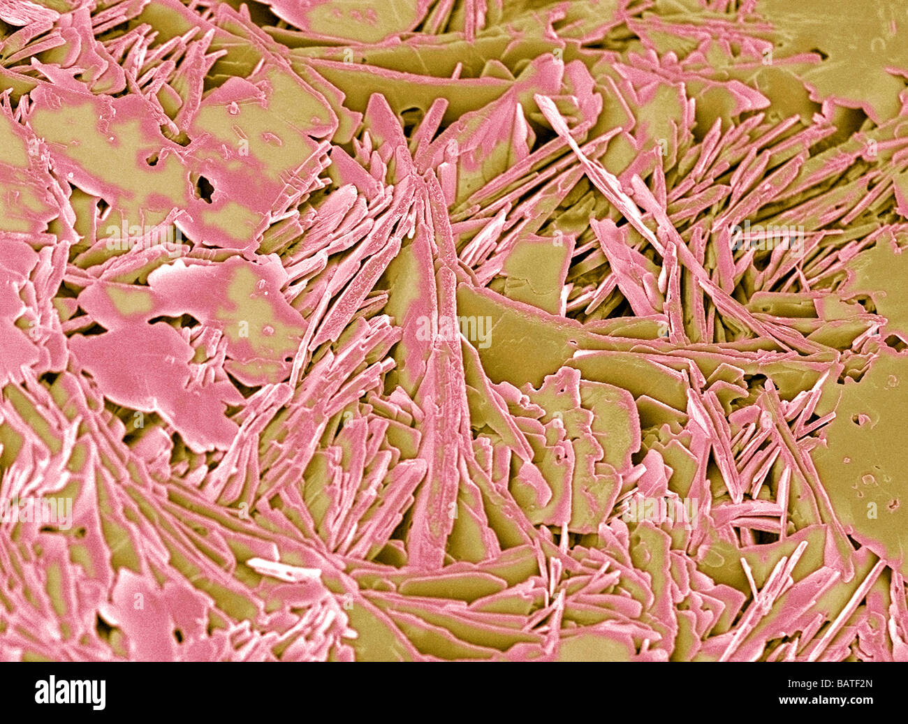 Gallstone. Coloured scanning electron micrograph(SEM) of a fractured ...