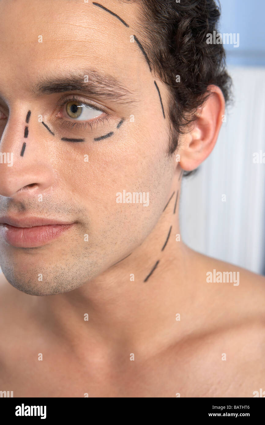 Cosmetic surgery. Patient with marks on his face in preparation for ...