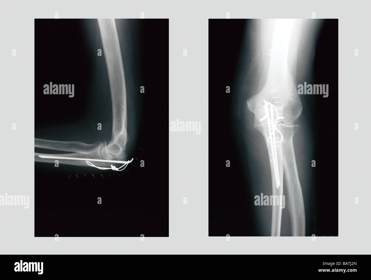 Shattered Elbow Repair Stock Photo - Alamy