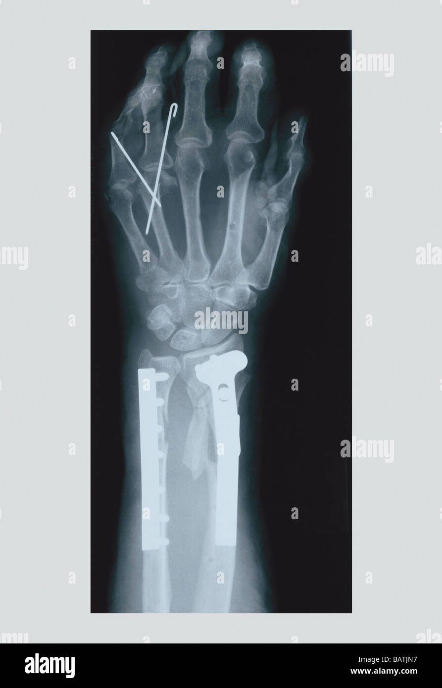 Arm and Finger Repair Stock Photo - Alamy