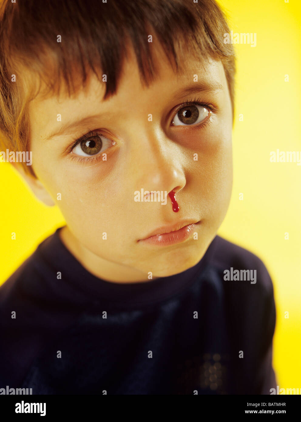 Nosebleed. 7-year-old boy with a nosebleed. Nosebleeds are most ...