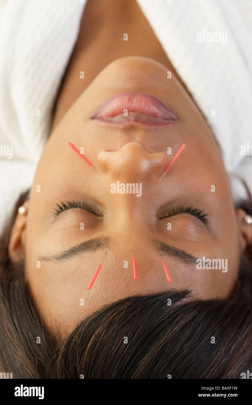 Acupuncture needles in African woman's face Stock Photo - Alamy