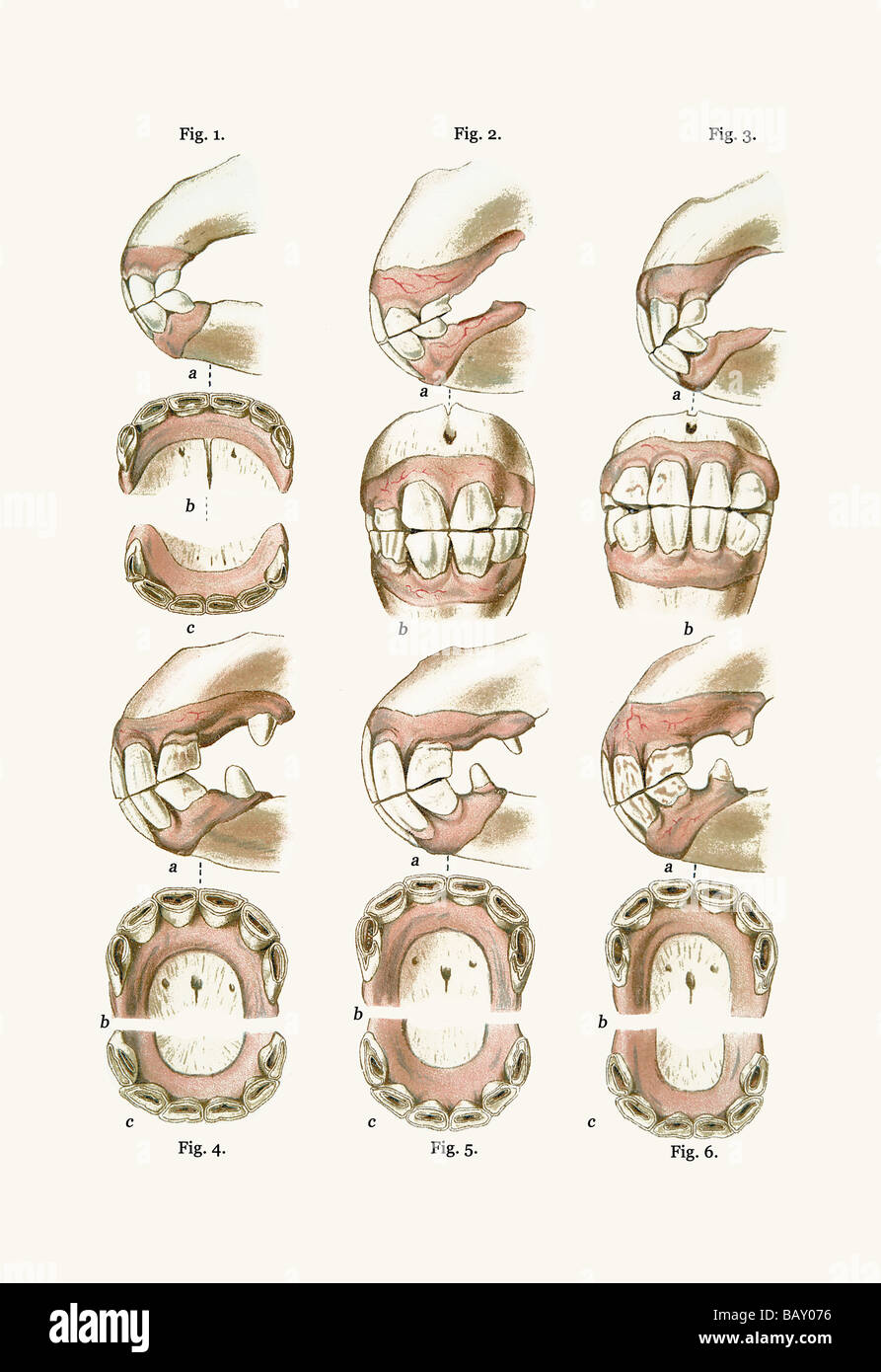 Teeth Plate Description Stock Photo - Alamy