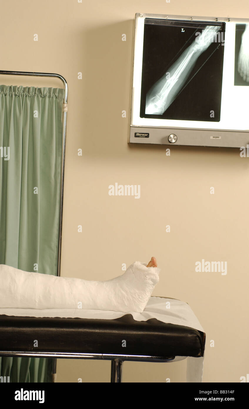 a person lying on a hospital bed with their broken leg in a cast Stock ...