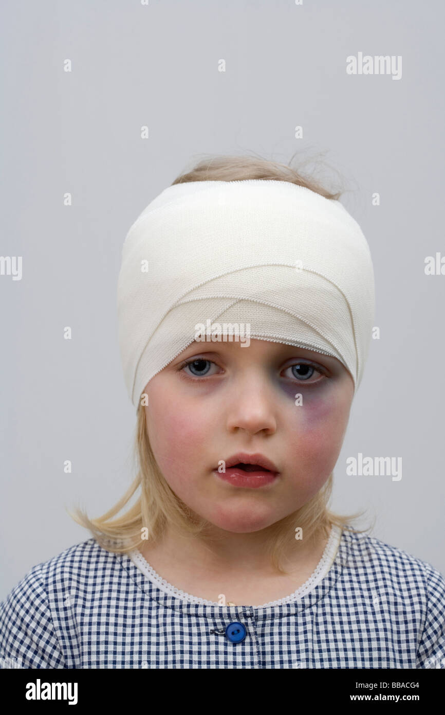 Black eye, child bruise hi-res stock photography and images - Alamy