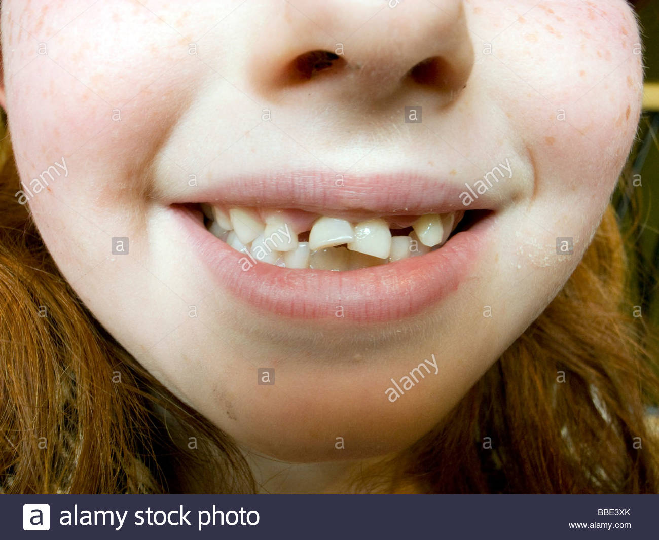 Wobbly Tooth High Resolution Stock Photography and Images - Alamy