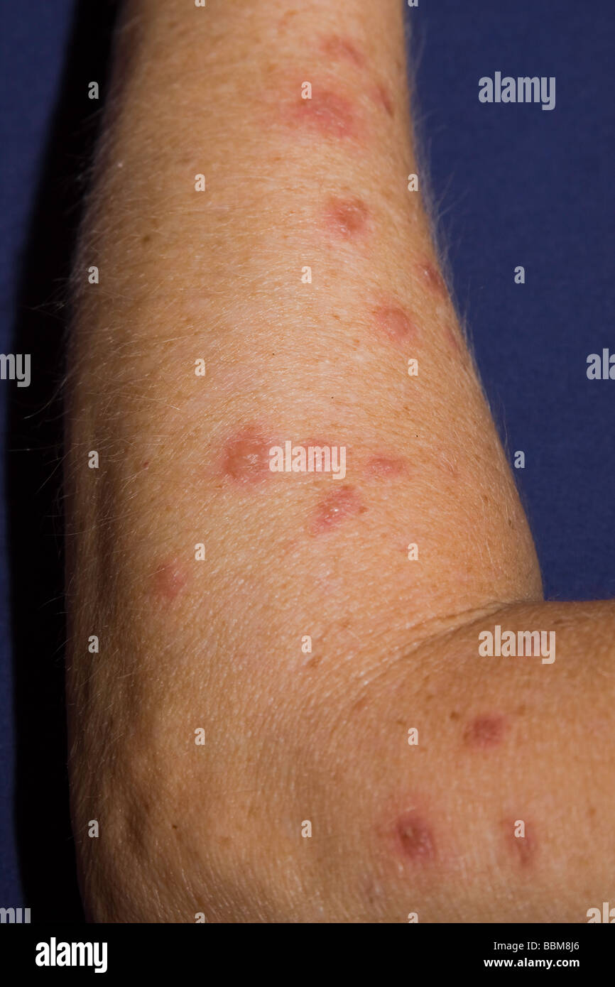 Freezing skin cancer hi-res stock photography and images - Alamy