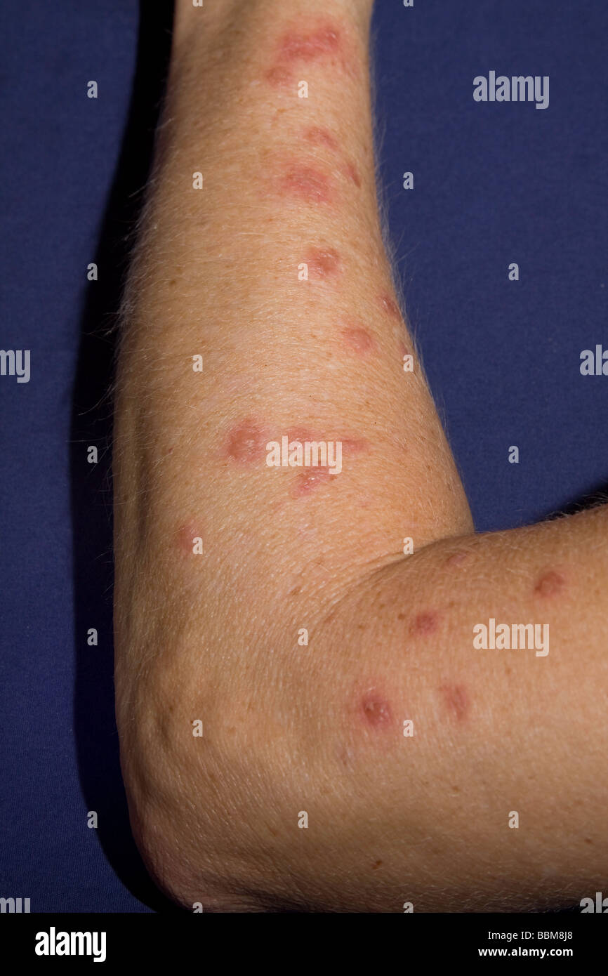 Freezing skin cancer hi-res stock photography and images - Alamy