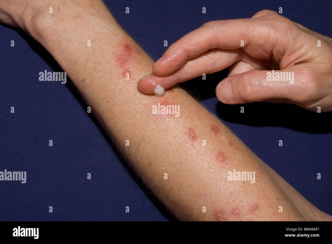 Freezing skin cancer hi-res stock photography and images - Alamy
