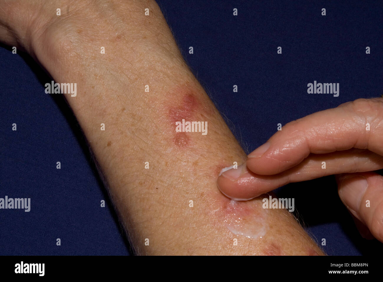 Freezing skin cancer hi-res stock photography and images - Alamy