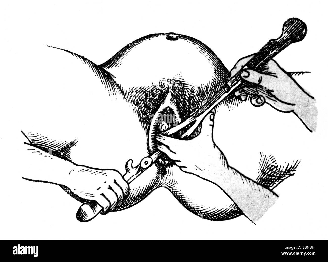 Obstetrics forceps Cut Out Stock Images & Pictures - Alamy