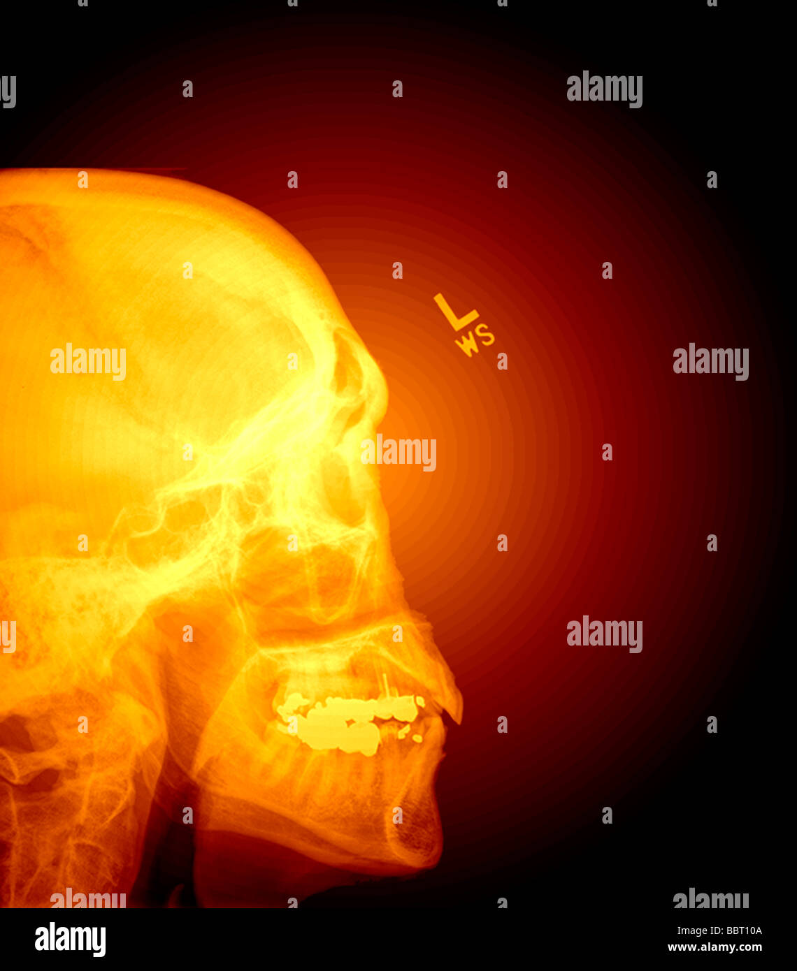color coded digital x-ray human skull computer monitor Stock Photo - Alamy