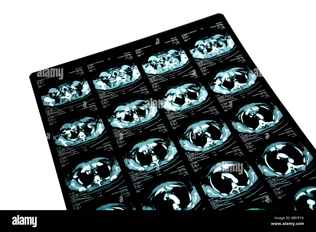 Radiology findings hi-res stock photography and images - Alamy