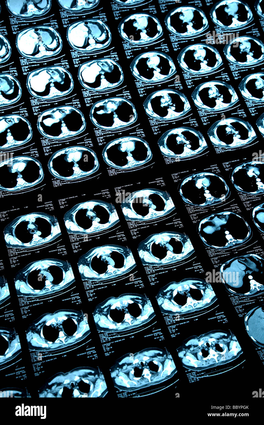 Radiology findings hi-res stock photography and images - Alamy