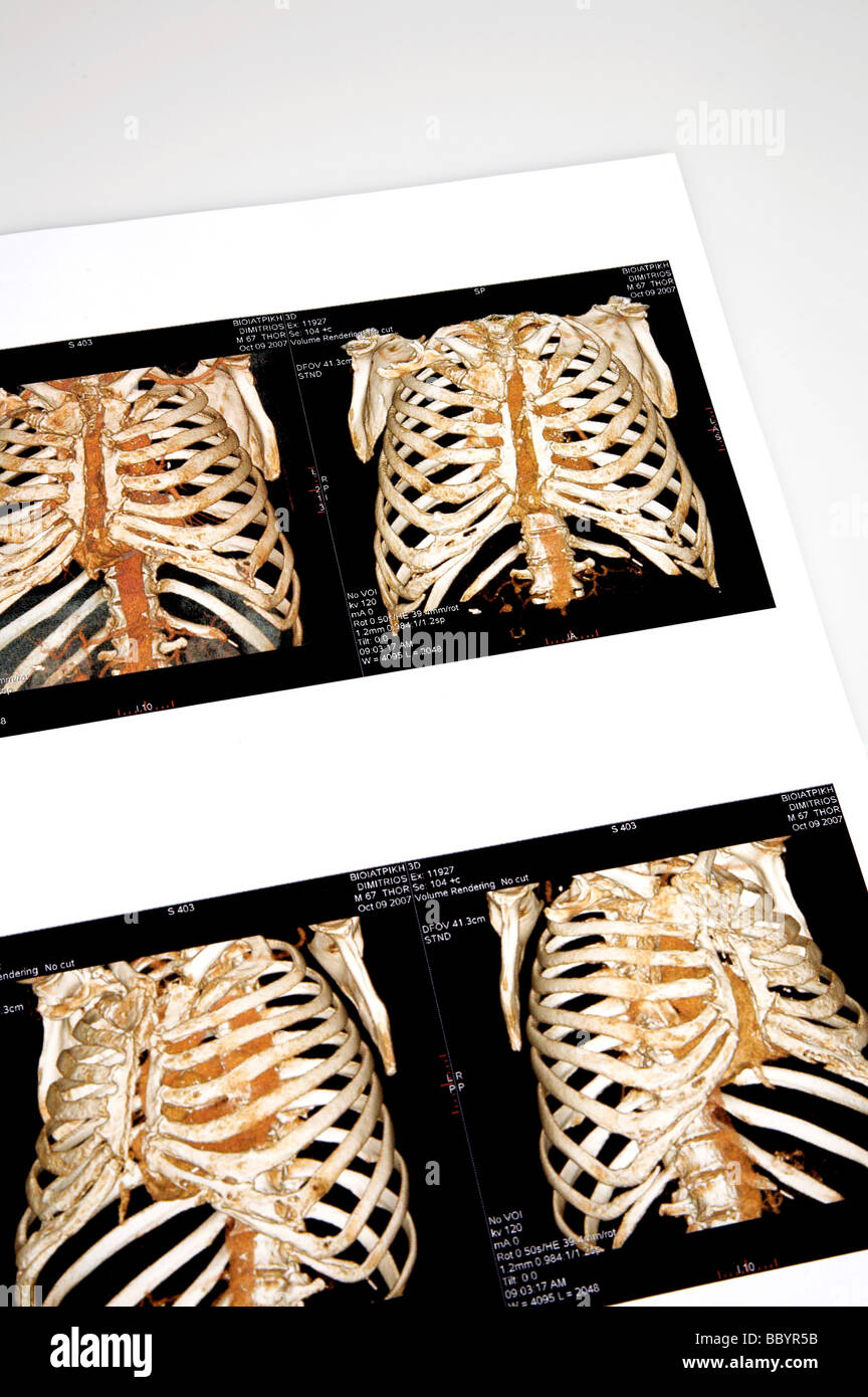 Chest thorax hi-res stock photography and images - Alamy