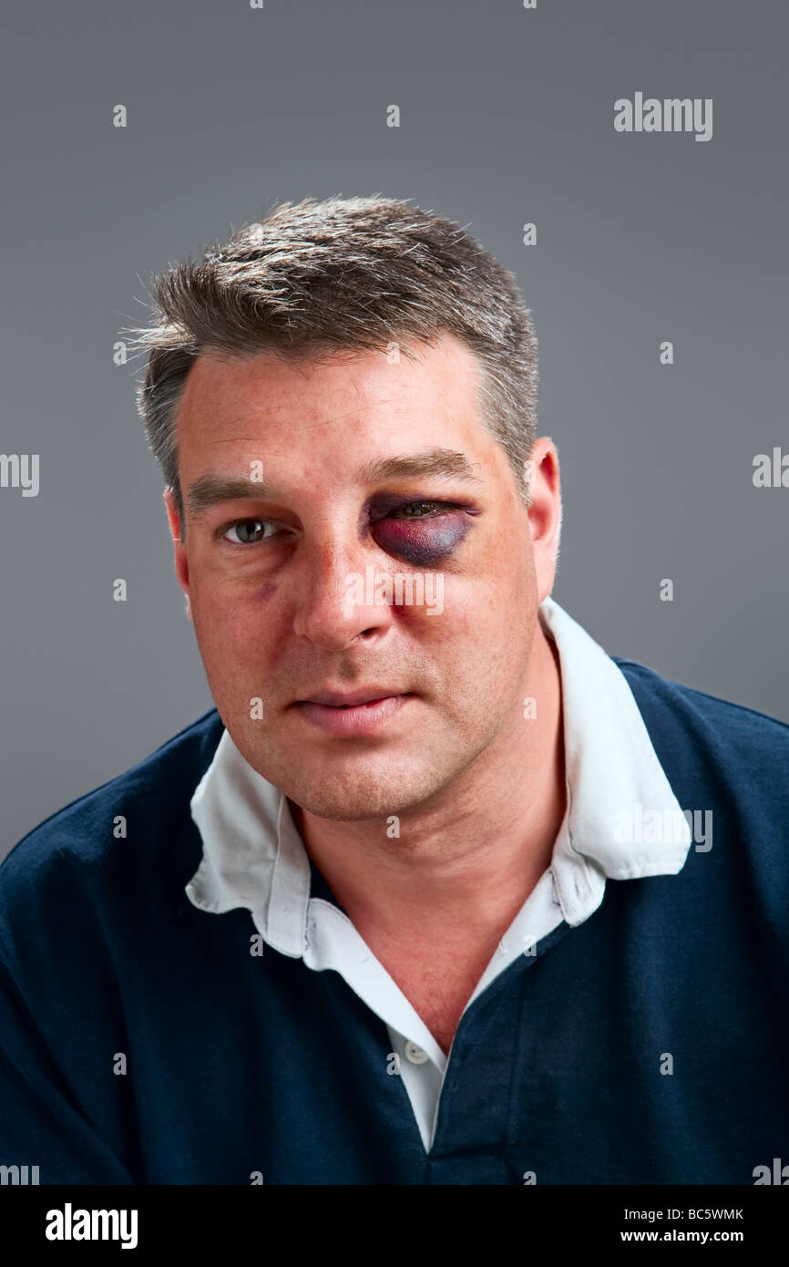 Male bruised face hi-res stock photography and images - Alamy