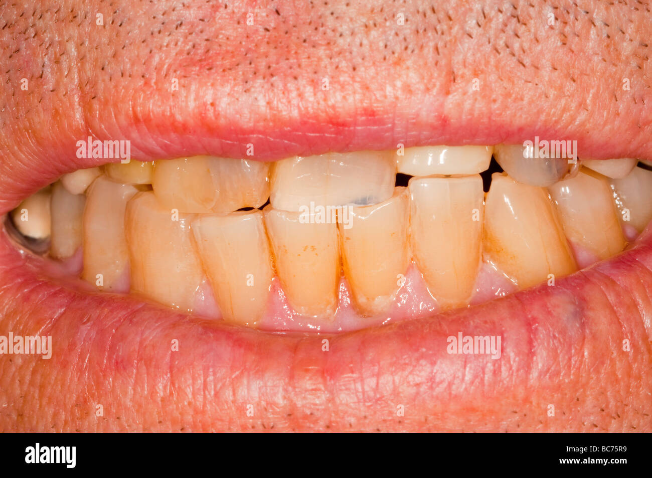 A close up of an elderly mans yellow stained teeth Stock Photo - Alamy