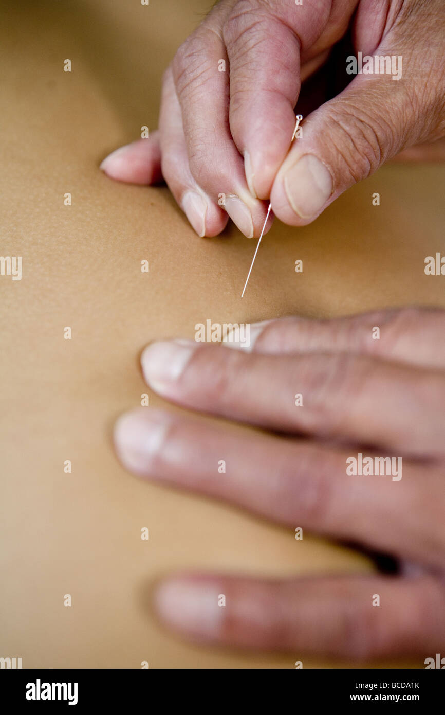 Inserting Acupuncture Needles High Resolution Stock Photography and ...