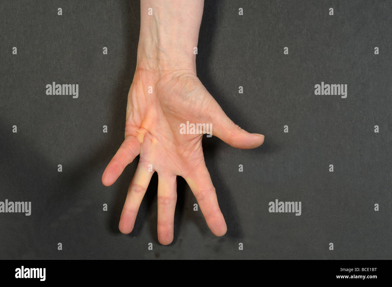 Dupuytrens syndrome hi-res stock photography and images - Alamy