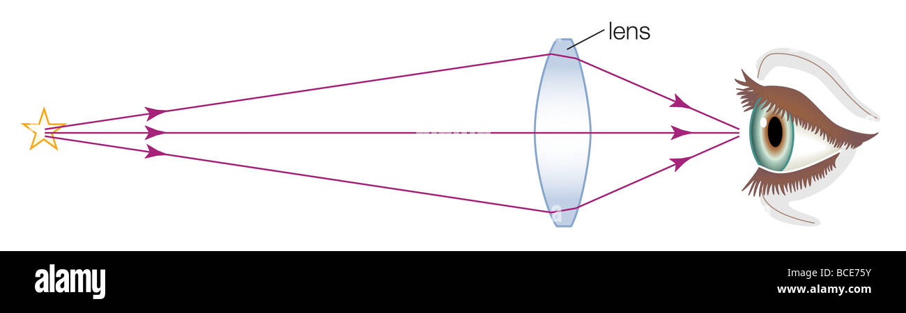 A converging lens focuses the rays from a distant object by causing ...