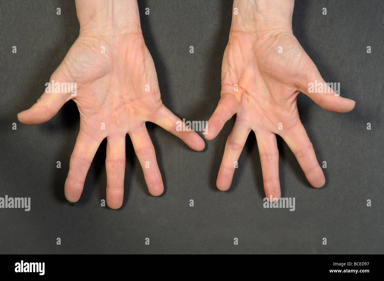 Dupuytrens contracture hand surgery hi-res stock photography and images ...