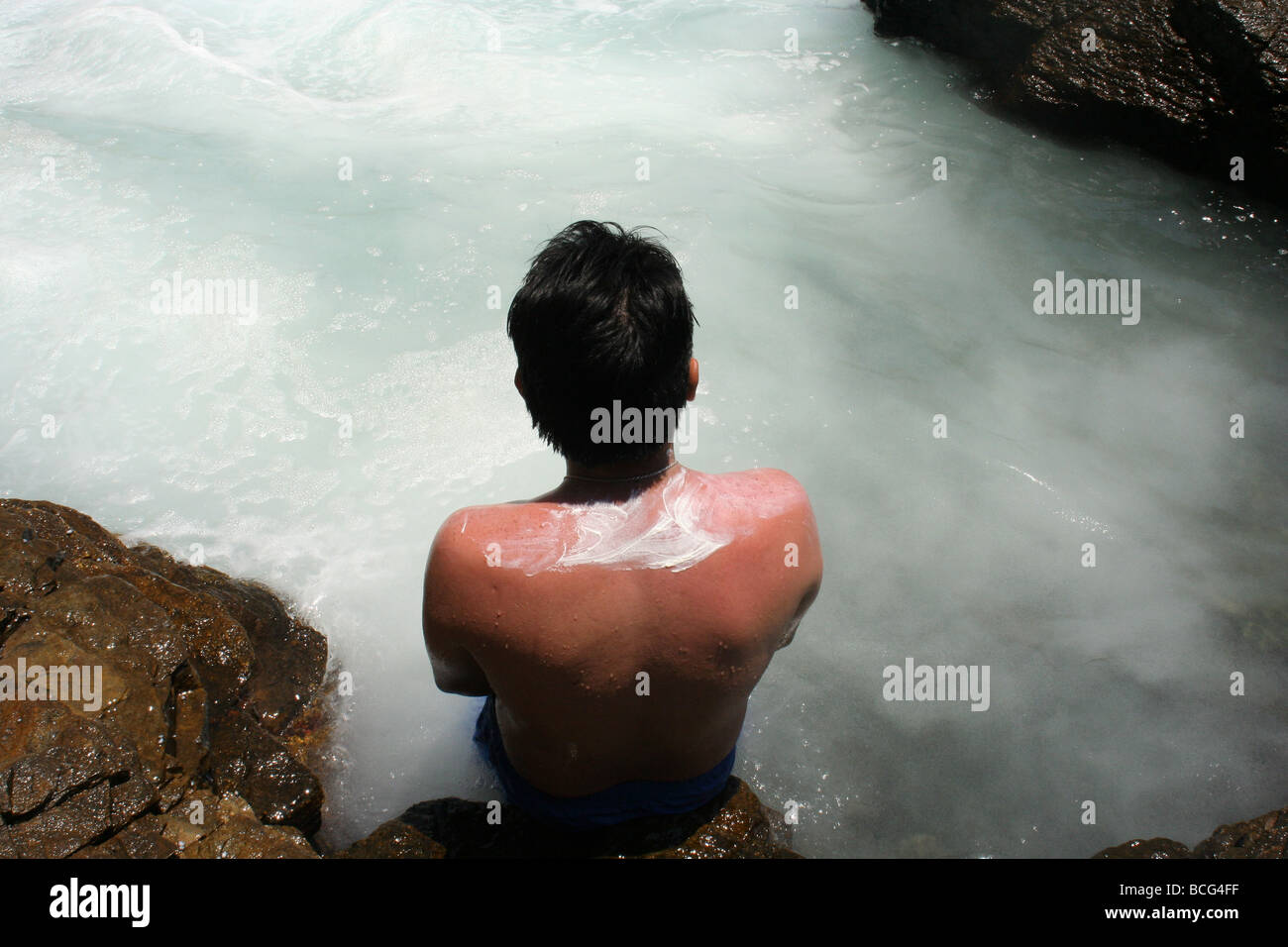 Burned by the sun Stock Photo - Alamy