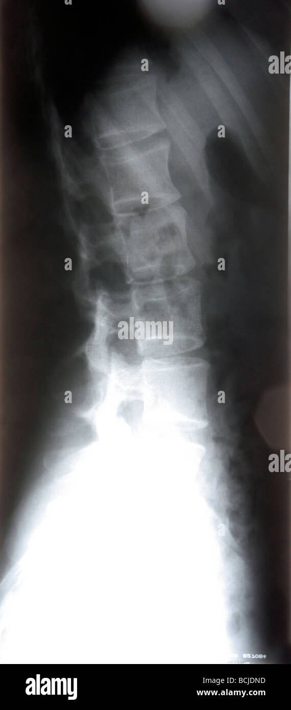 X-ray of the spinal column Stock Photo - Alamy
