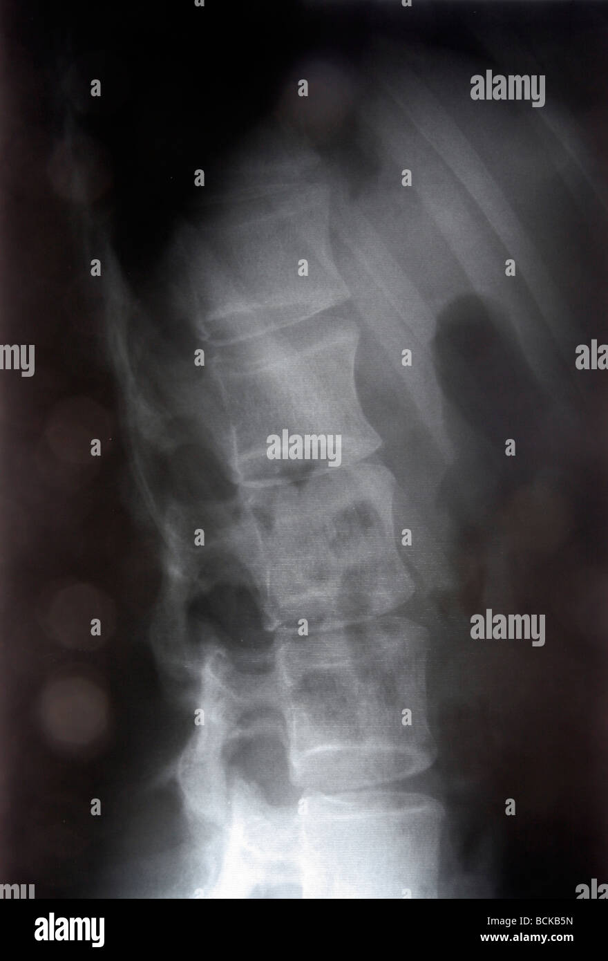 X-ray of the spinal column Stock Photo - Alamy