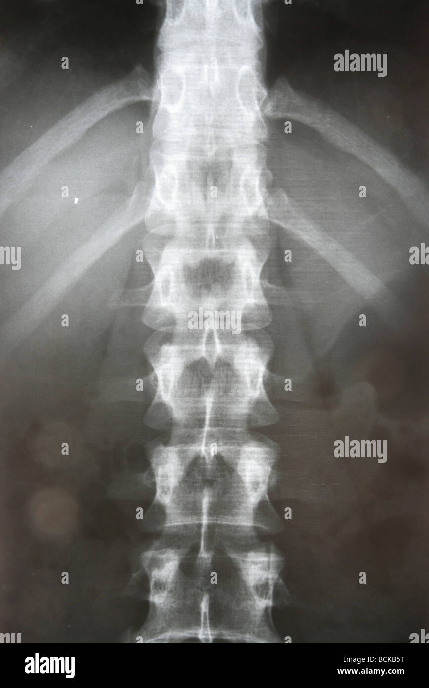 X-ray of the spinal column Stock Photo - Alamy X-ray of the spinal column Stock Photo - Alamy