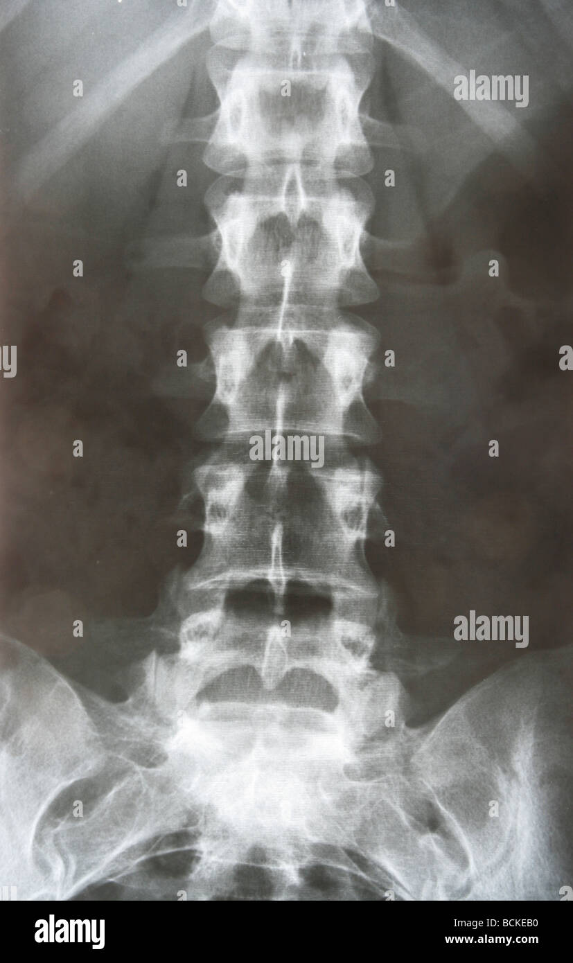 X-RAY film of lower thorax and pelvis Stock Photo - Alamy