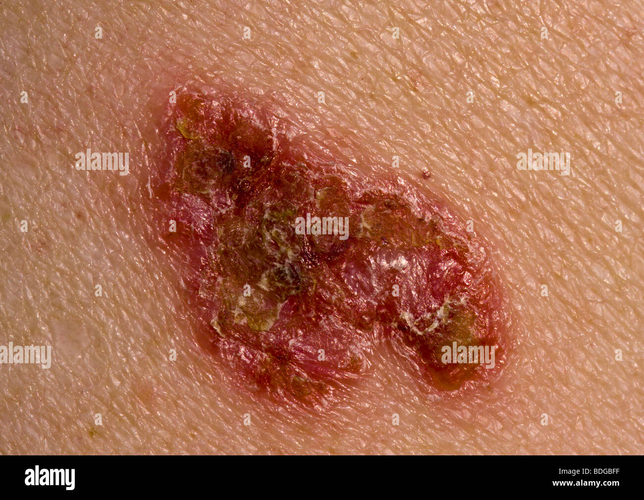 Ulcus rodens hi-res stock photography and images - Alamy