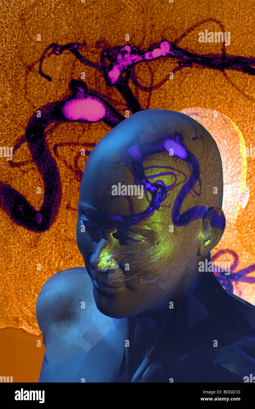 ANEURYSM OF THE BRAIN, ANGIOGR Stock Photo - Alamy