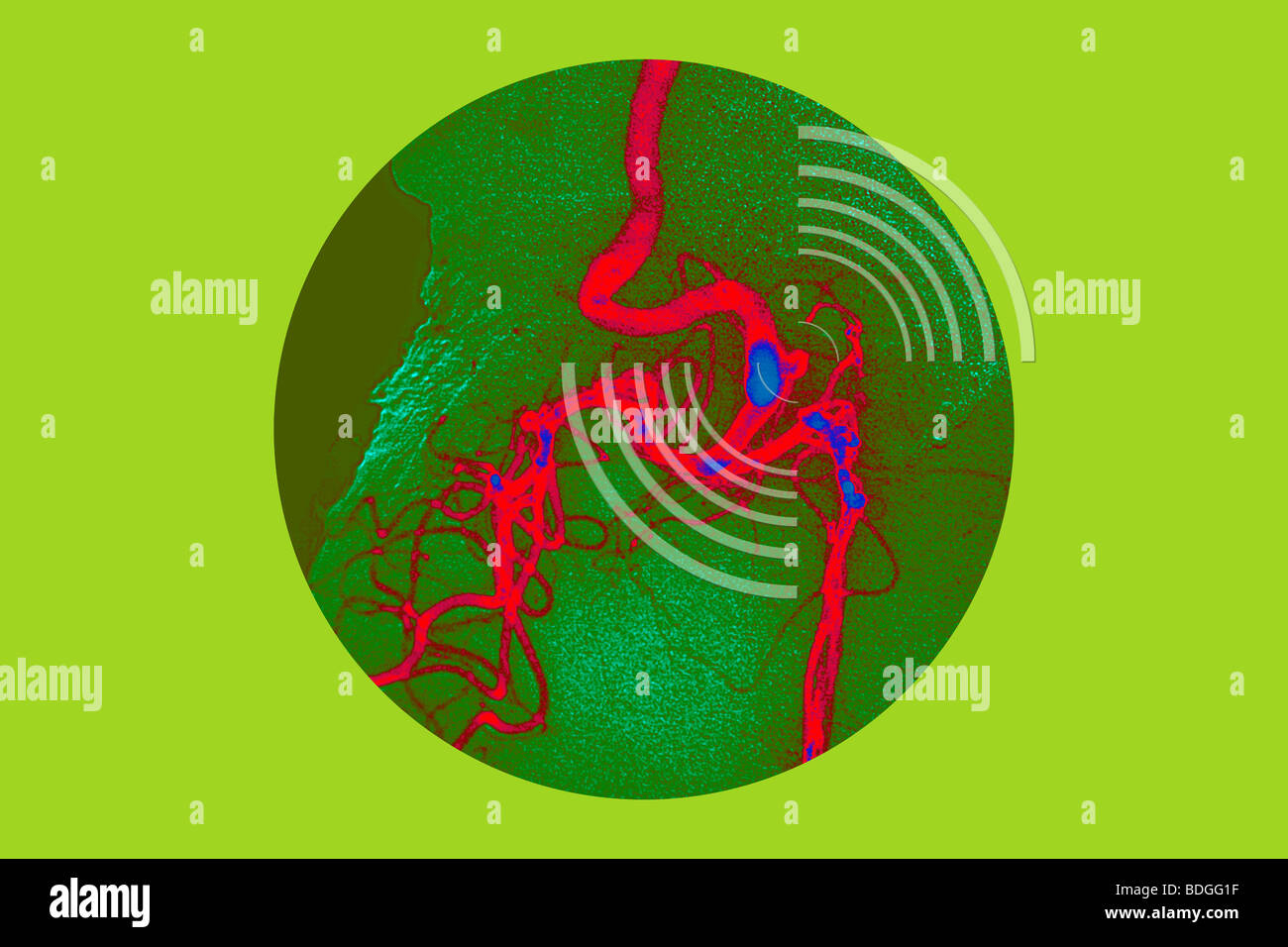 ANEURYSM OF THE BRAIN, ANGIOGR Stock Photo - Alamy