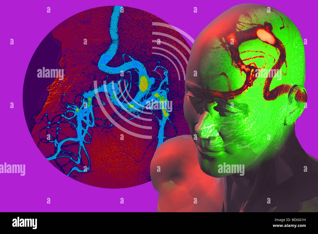 ANEURYSM OF THE BRAIN, ANGIOGR Stock Photo - Alamy