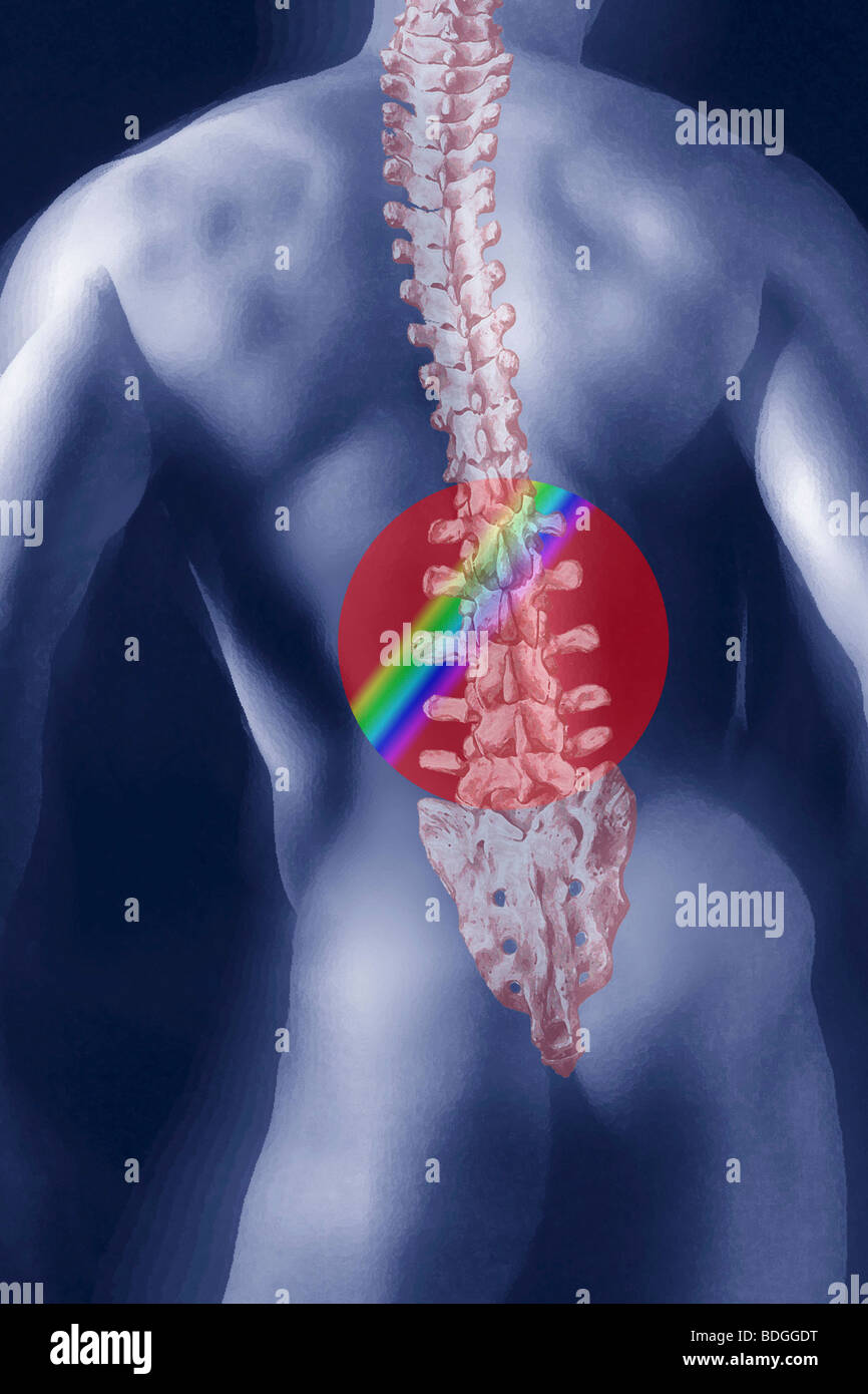 BACK PAIN, SYMBOL Stock Photo - Alamy