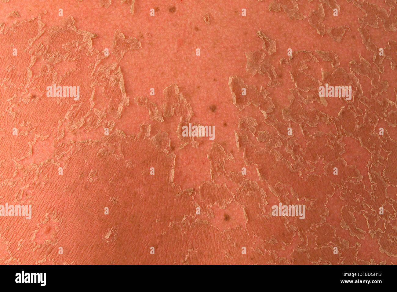 Erythema solar hi-res stock photography and images - Alamy